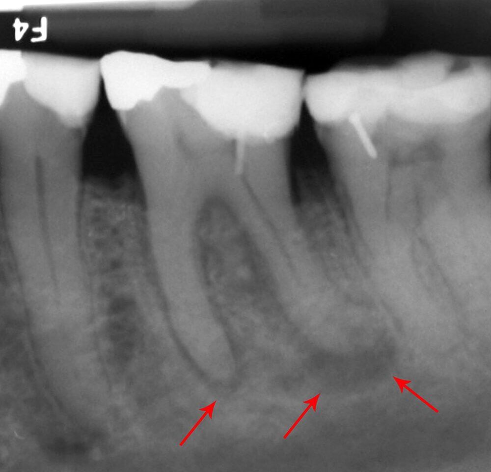 Abscessed Tooth Symptoms - Smiles Movement